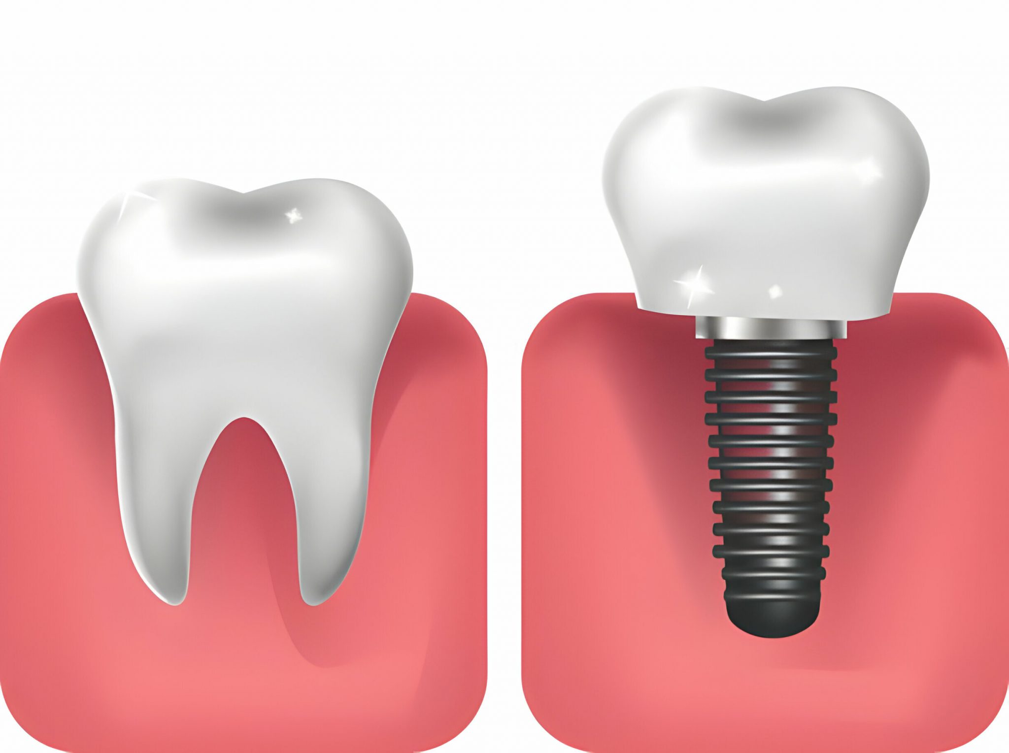 Securing Your Smile: A Guide On How To Fix Loose Dental Implants